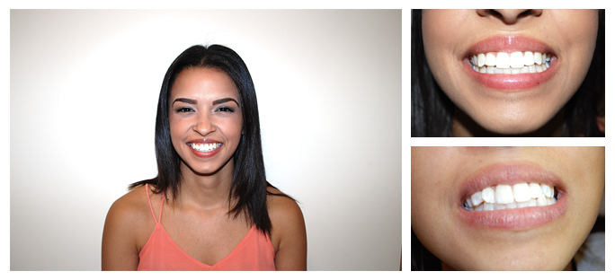 Veneers in Chesterfield, VA | Bright Smiles Dental